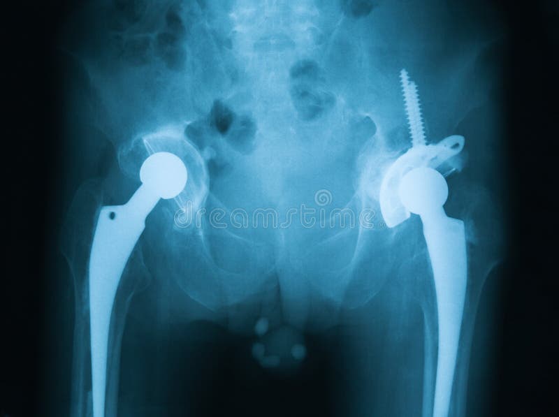 X-ray Image of Both Hip, Showing Hip Replacement Stock Image - Image of ...