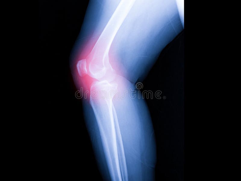 X-ray Image of Both Knee, Human`s Knee Joints Stock Photo - Image of ...