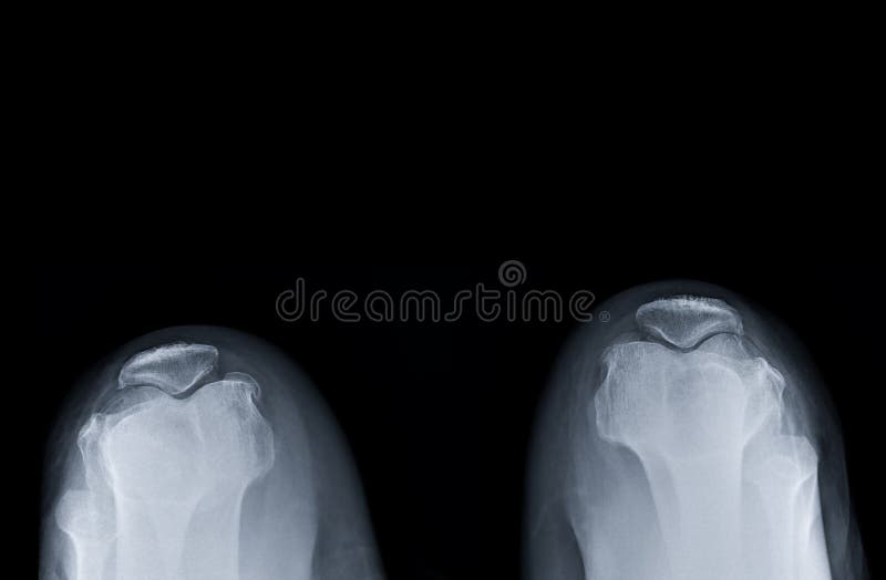 X-ray Image of Both Normal Patella Stock Photo - Image of medicine ...