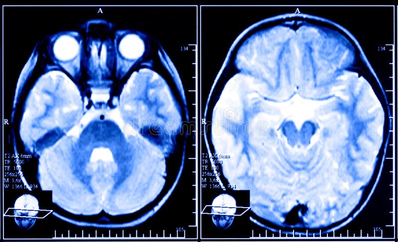 X-ray image of the brain stock photo. Image of computer - 27128084