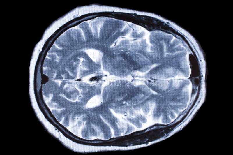 X-ray Image of the Brain Computed Tomography Stock Photo - Image of ...
