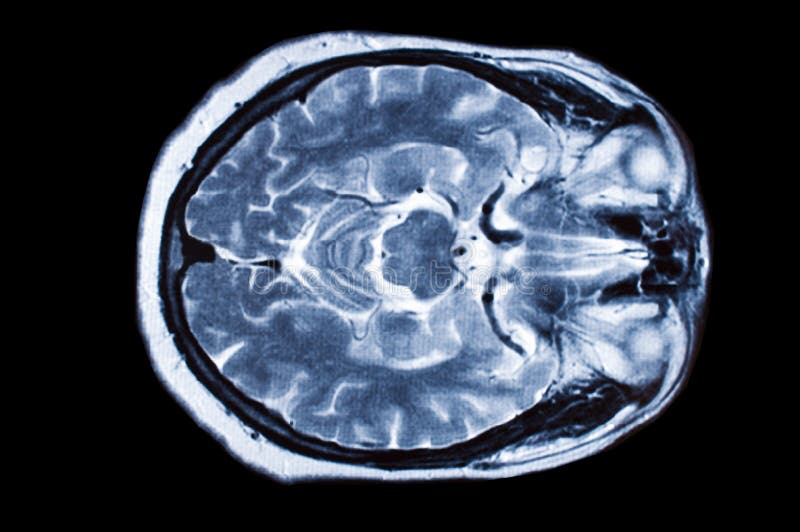 X-ray Image of the Brain Computed Tomography Stock Image - Image of ...
