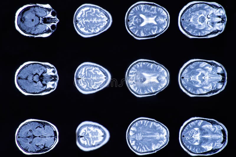 X-ray Image of the Brain Computed Tomography, Imaging of the Brain ...