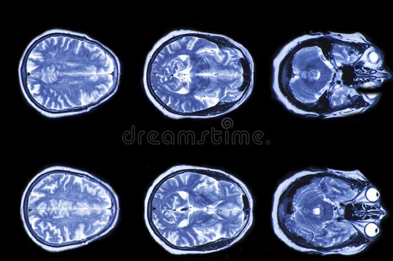 X-ray Image of the Brain Computed Tomography Stock Photo - Image of ...