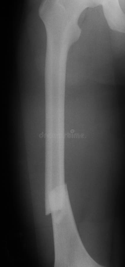 X-ray Image of Femur Fracture, Lateral View, Stock Photo - Image of ...