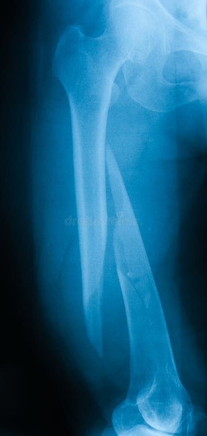 X-ray Image of Femur Fracture, Lateral View, Stock Photo - Image of ...