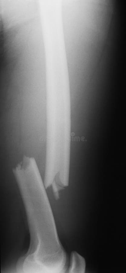 X-ray Image of Broken Femur. Stock Photo - Image of examining, doctor ...