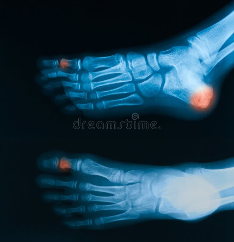 X-ray Image of Broken Foot, AP and Lateral View. Stock Image - Image of ...