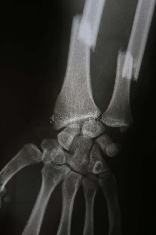 X-ray Image of Broken Forearm, AP and Lateral View Show Fracture Stock ...