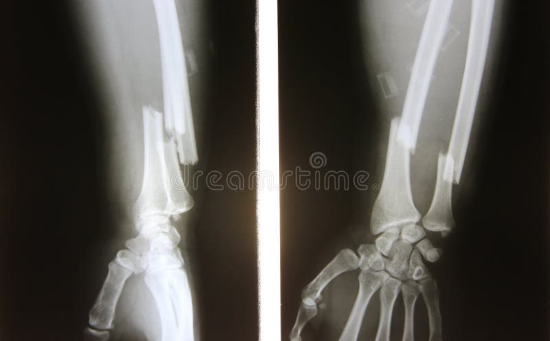 Xray Image Of Broken Leg Ap And Lateral View Stock