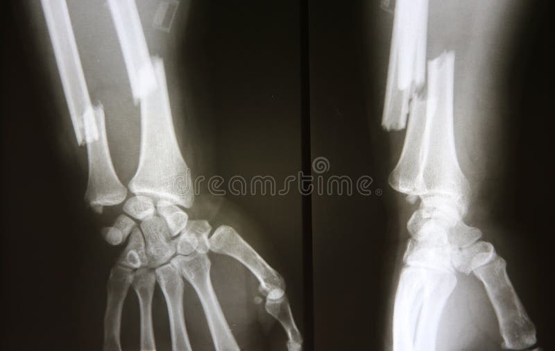 X-ray Image of Broken Forearm, AP and Lateral View Show Fracture Stock ...