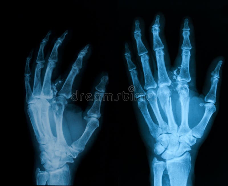 X-ray Image of Broken Hand, AP and Oblique View. Stock Photo - Image of ...