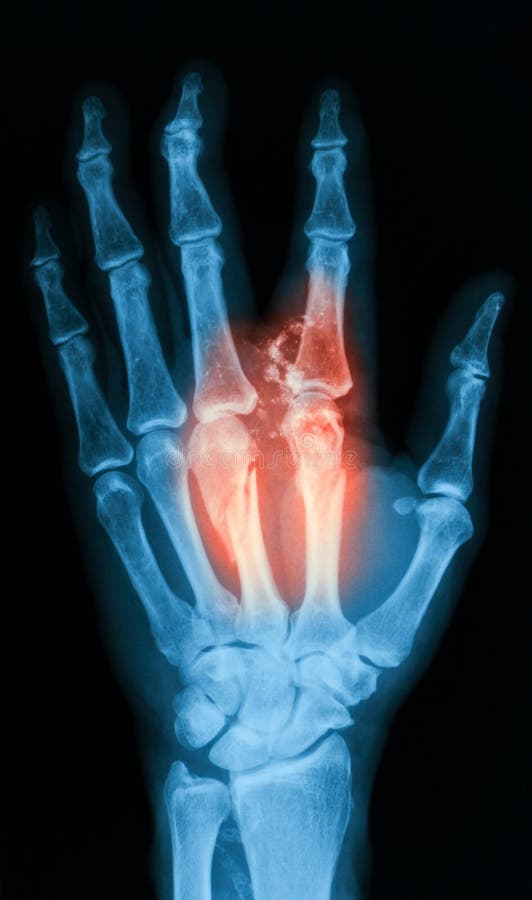 X Ray Broken Hand