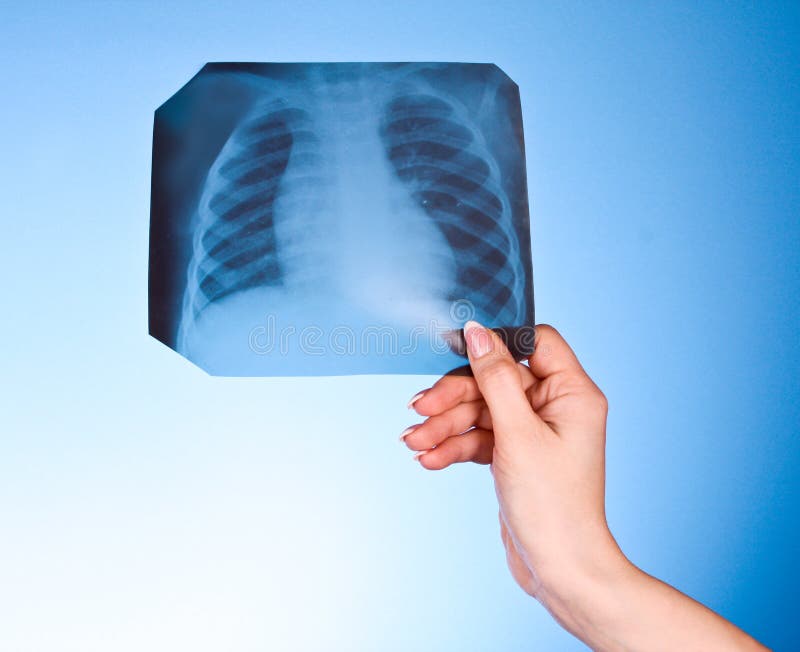 X-Ray Image of Chest on Blue Background Stock Photo - Image of lung ...