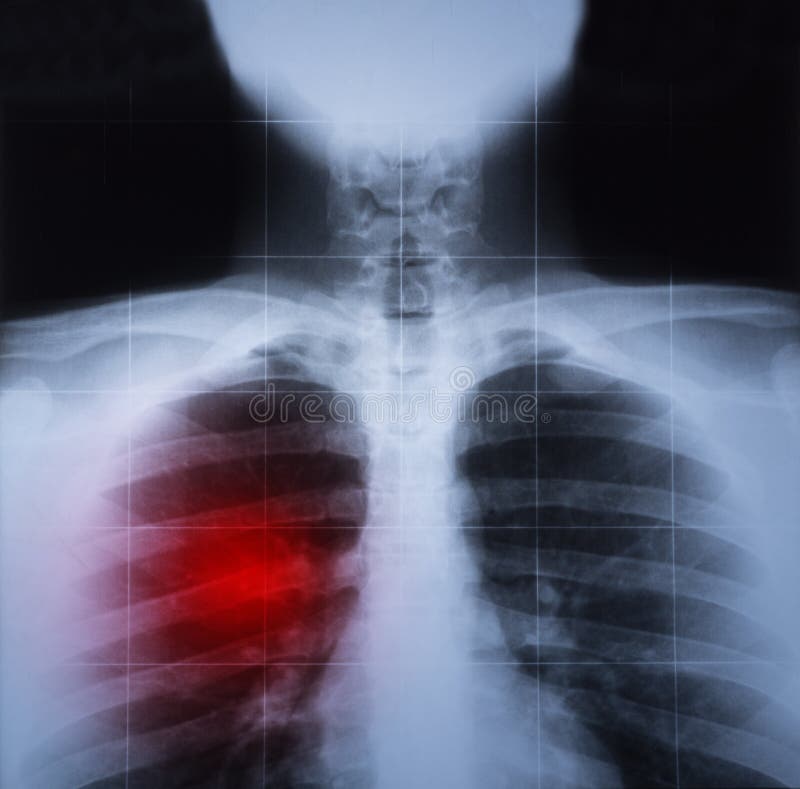 X Ray Image of Chest and Lung Disease Highlighted in Red Stock Photo ...