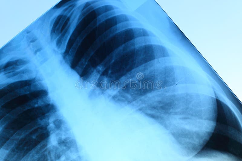 CT of chest bones stock photo. Image of computed, body - 8366298
