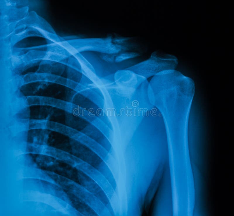 X-ray of Clavicle AP View Showing Fracture of Left Clavicle Bone Stock ...