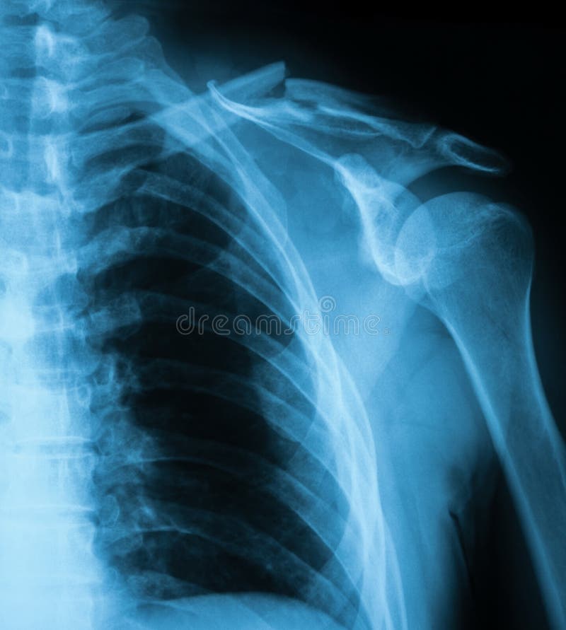 X-ray Image of Clavicle, AP View. Stock Image - Image of people, human ...