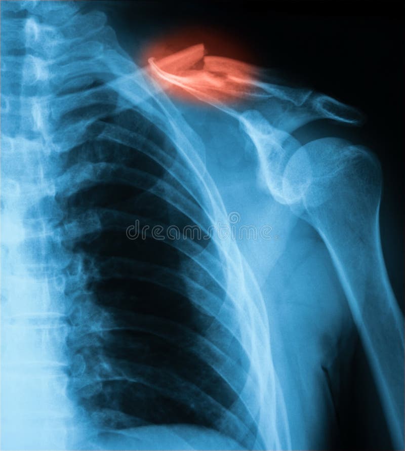 X-ray Image of Clavicle, AP View. Stock Photo - Image of room, lung ...