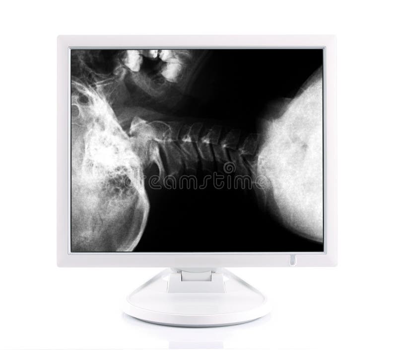 X-ray image and computer stock photo. Image of medicine - 19652728