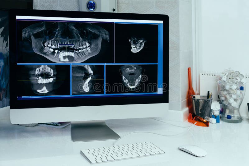 X Ray Image of a Computer in a Dentist S Office Stock Image - Image of ...