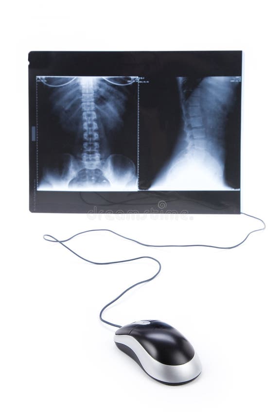 X-ray Image and Computer Mouse Stock Photo - Image of diagnoses, human ...