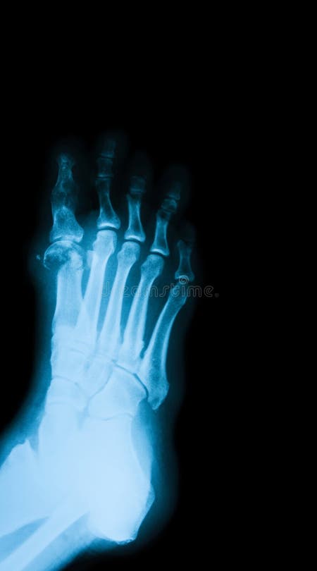 X-ray Image of Diabetic Foot. Stock Image - Image of medicine, human ...