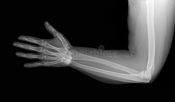 X-ray Image of the Elbow Joint, without Visible Traumatic and Bone ...