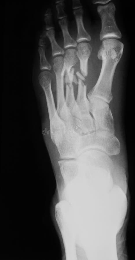 X-ray Image of Foot Oblique View, Stock Photo - Image of finger ...