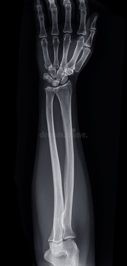 X-ray Image of Forearm Bone Stock Image - Image of bone, pain: 270264119