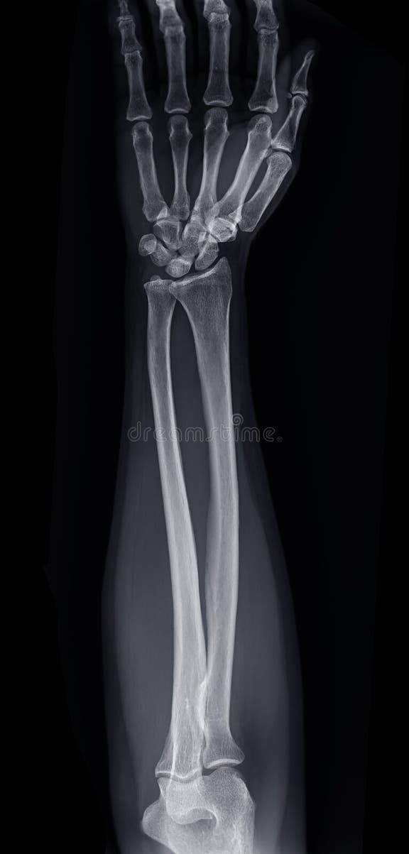 X-ray Image of Forearm Bone Stock Image - Image of bone, pain: 270264119