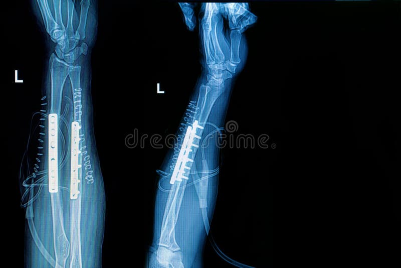X-ray Image of Forearm, AP View (Antero-posterior View, Show Fra Stock ...