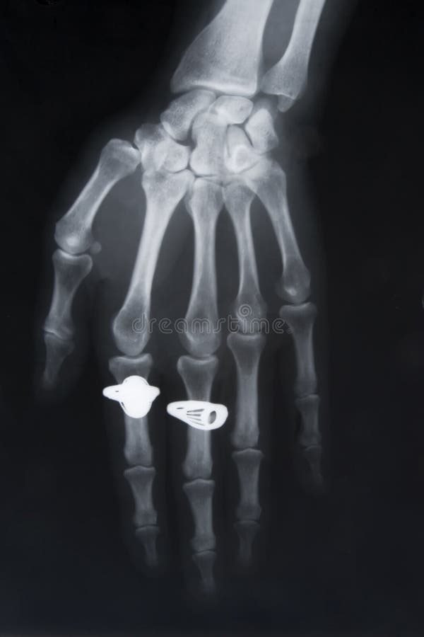 X-ray Image of Hand with Two Rings Stock Image - Image of black ...