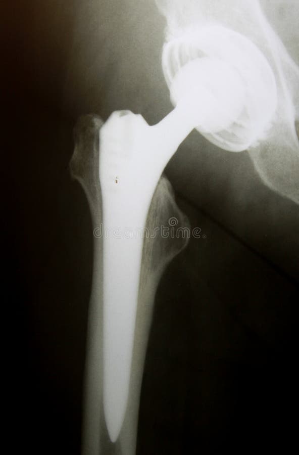 X-Ray Image of Hip with Implanted Artificial Joint Replacement ...