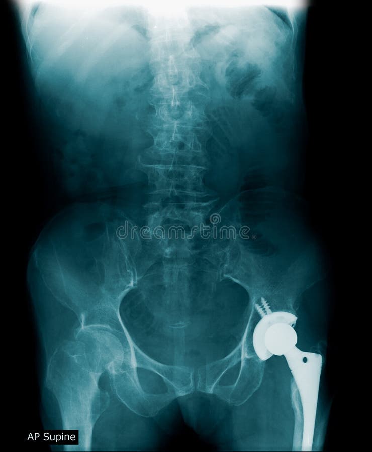 X Ray Female Right Hip Replacement Stock Photos - Free & Royalty-Free ...