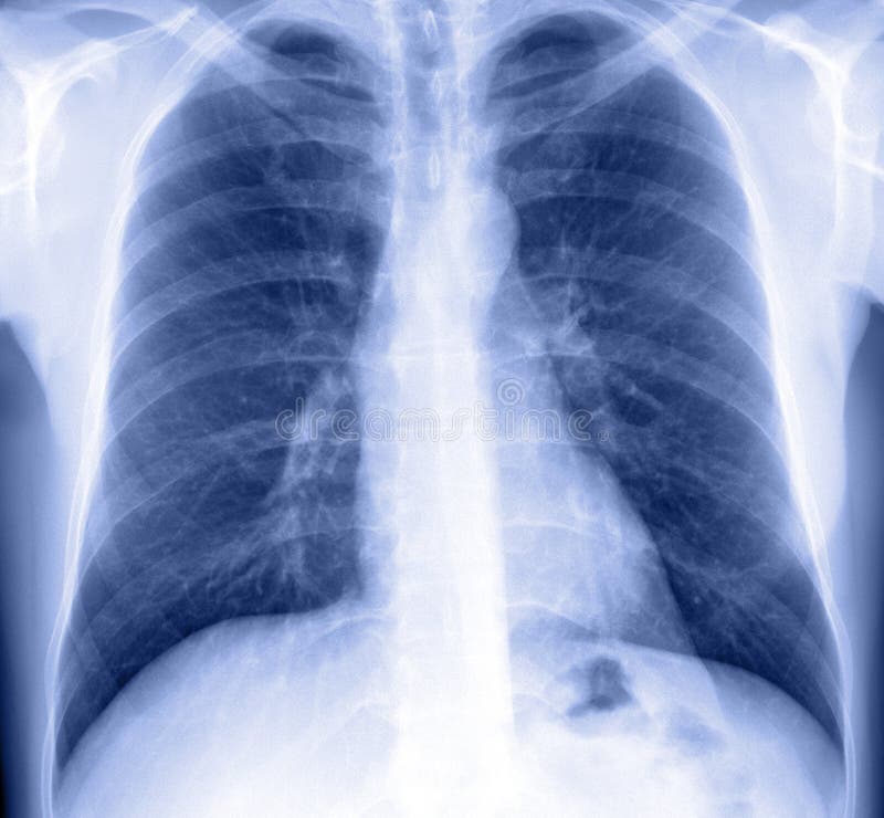 X-Ray Image of Human Chest stock photo. Image of scan - 205948992