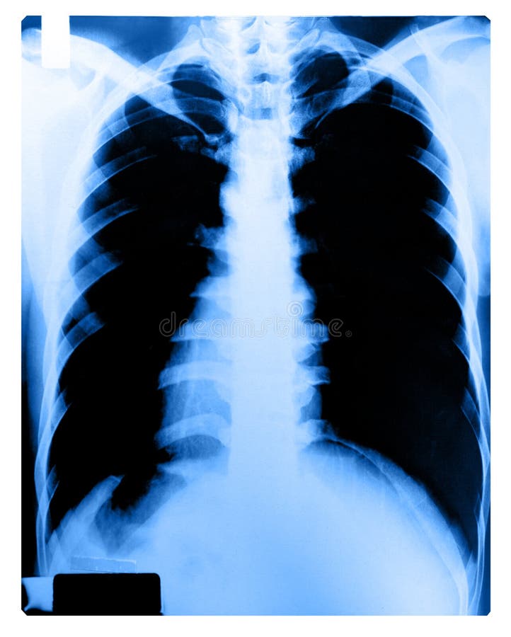 X-Ray Image Of Human Chest Picture. Image: 28707489