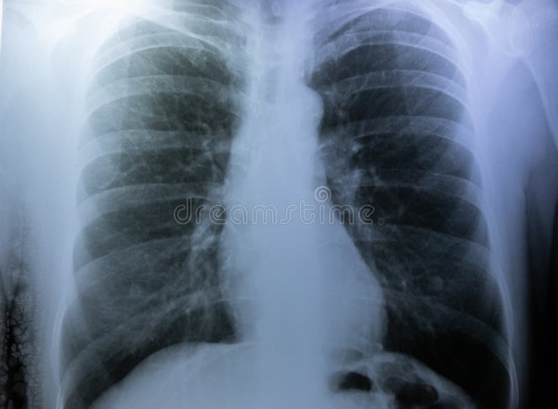 X Ray Image of a Human Chest Stock Photo - Image of exam, health: 262599904