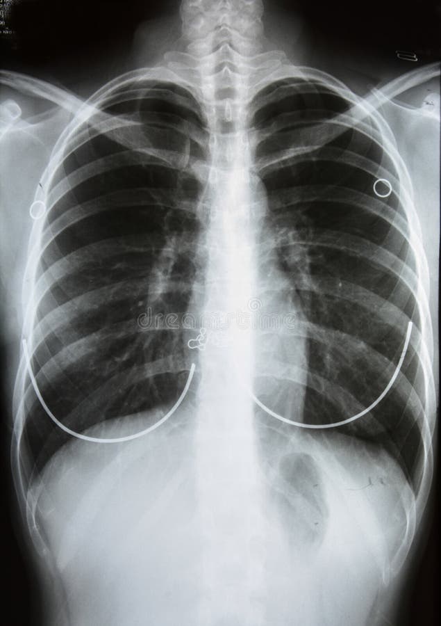 X-Ray Image of Human Chest stock image. Image of laboratory - 42382633