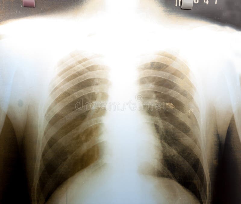 X-Ray Image of human chest stock photo. Image of disease - 73155572
