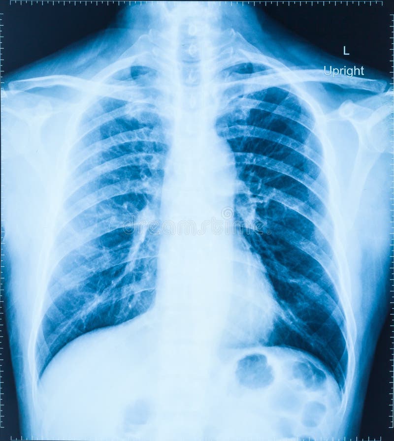 X-Ray Image of Human Chest for a Medical Diagnosis Stock Image - Image ...
