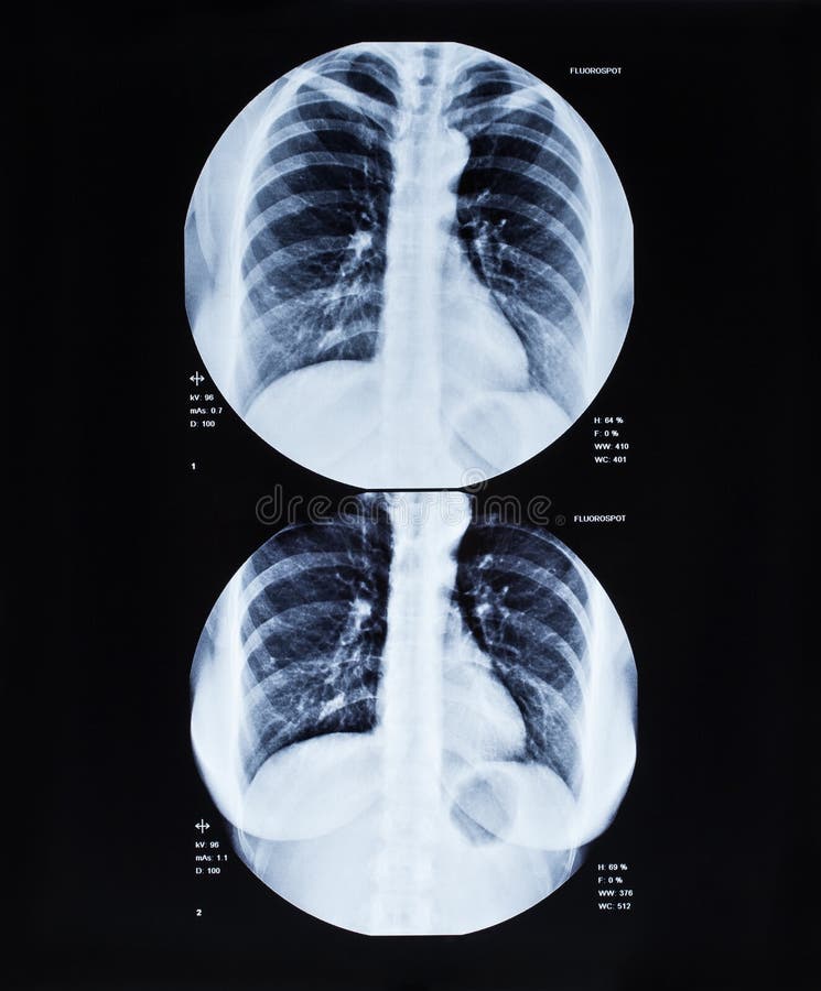 X-ray of a Human Chest or Lungs Radiography Shot, Medical Technology ...