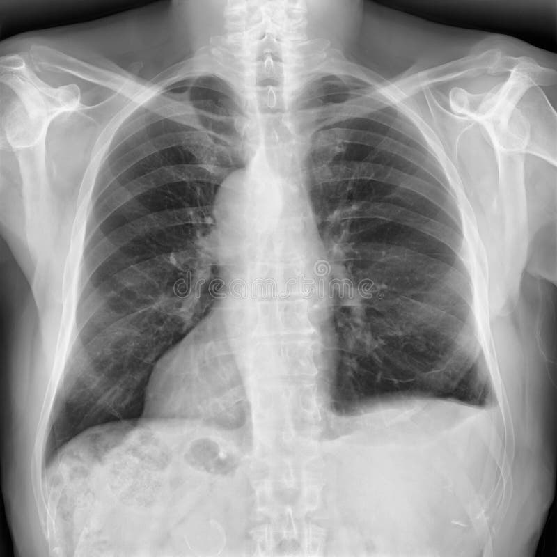X-Ray Image of Human Chest - TB Screening Stock Image - Image of ...