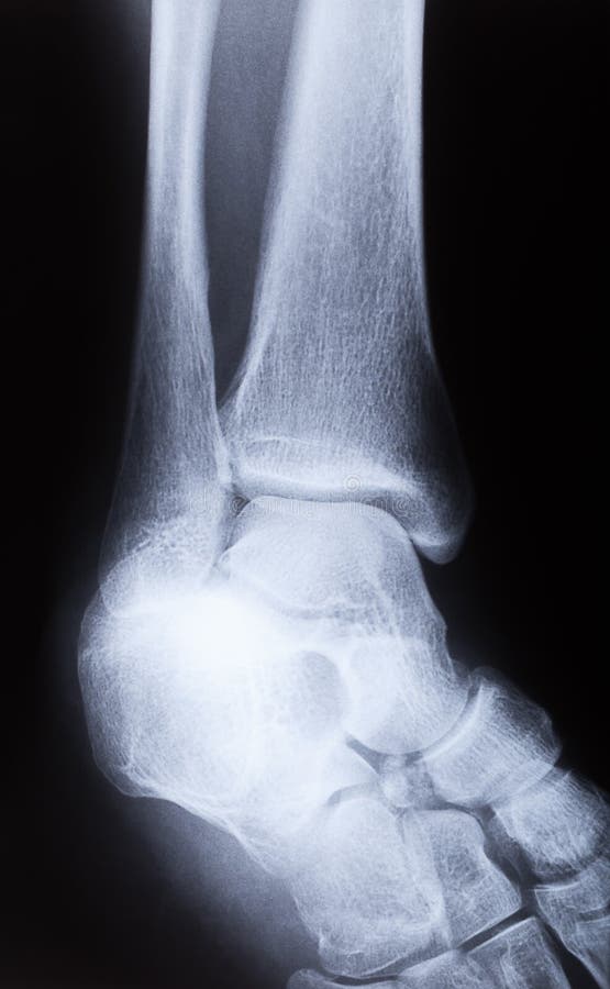 X-ray Image of Human Foot Joint , Side View Stock Image - Image of ...