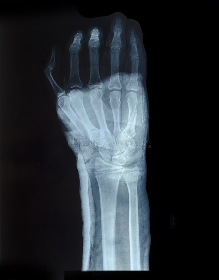 X Ray Of Pinky Finger Dislocation