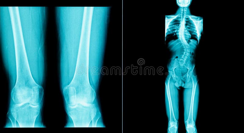 X-ray Image of Human Have a Long Bone Body Stock Photo - Image of bone ...