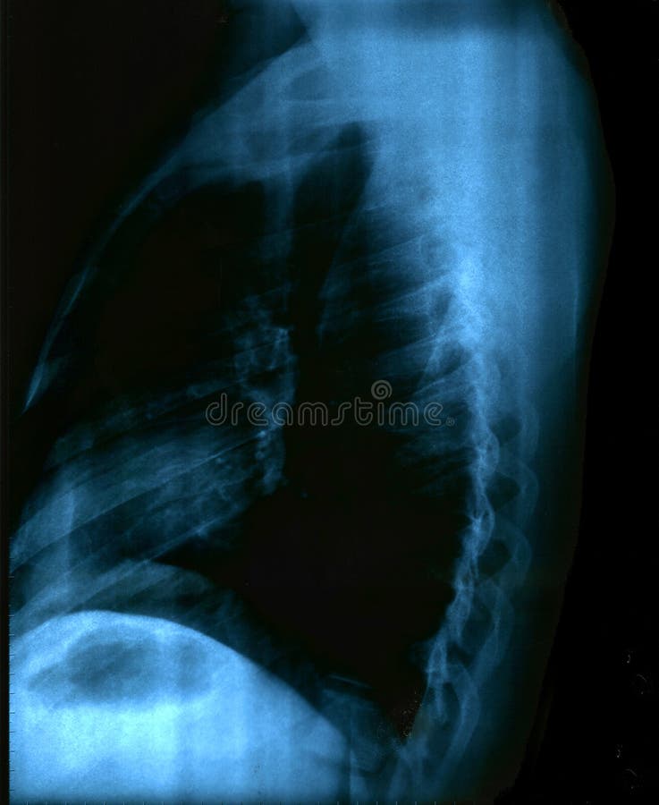 X-Ray Image of Human Healthy Chest Stock Image - Image of healthy ...