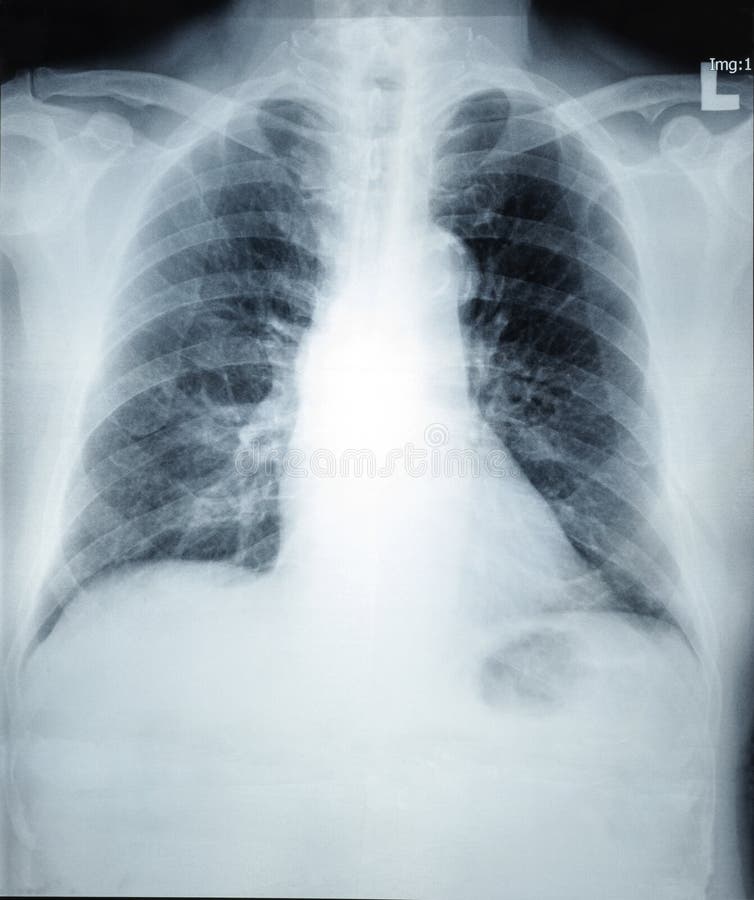 X-Ray Image of Human Healthy Chest Stock Photo - Image of hospital ...
