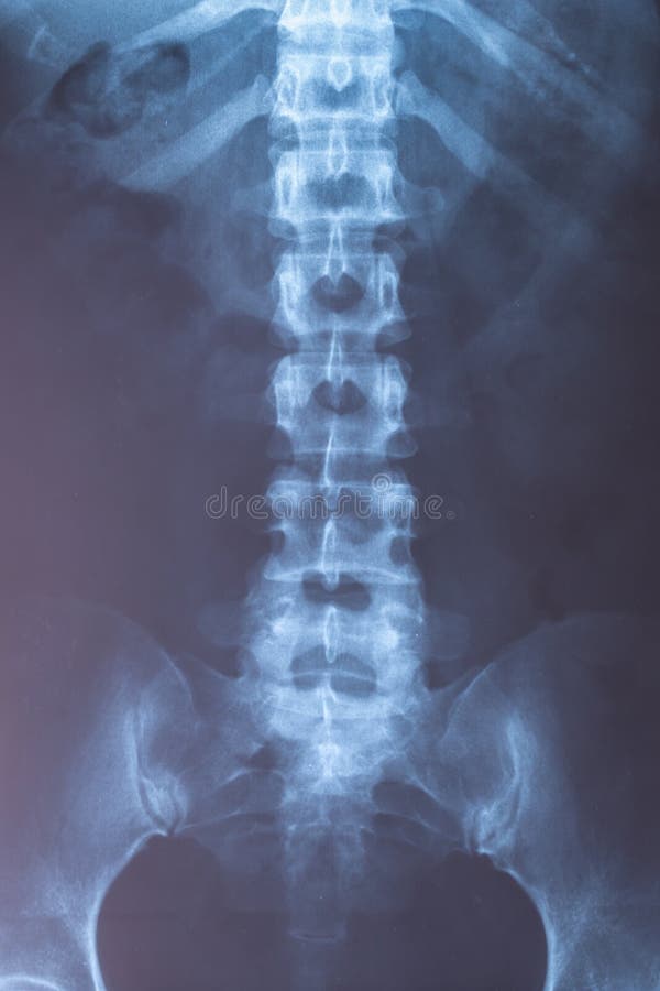 X-Ray Image of Human for a Medical Diagnosis Stock Image - Image of ...