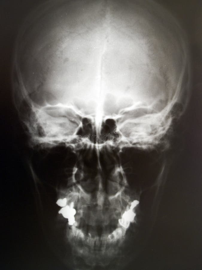X-ray image of human skull stock photo. Image of closeup - 644834